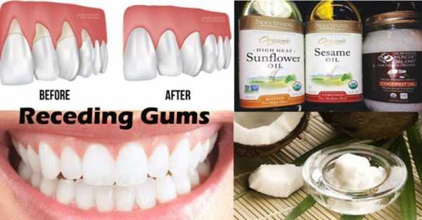 Home Remedies To Grow Back Receding Gums
